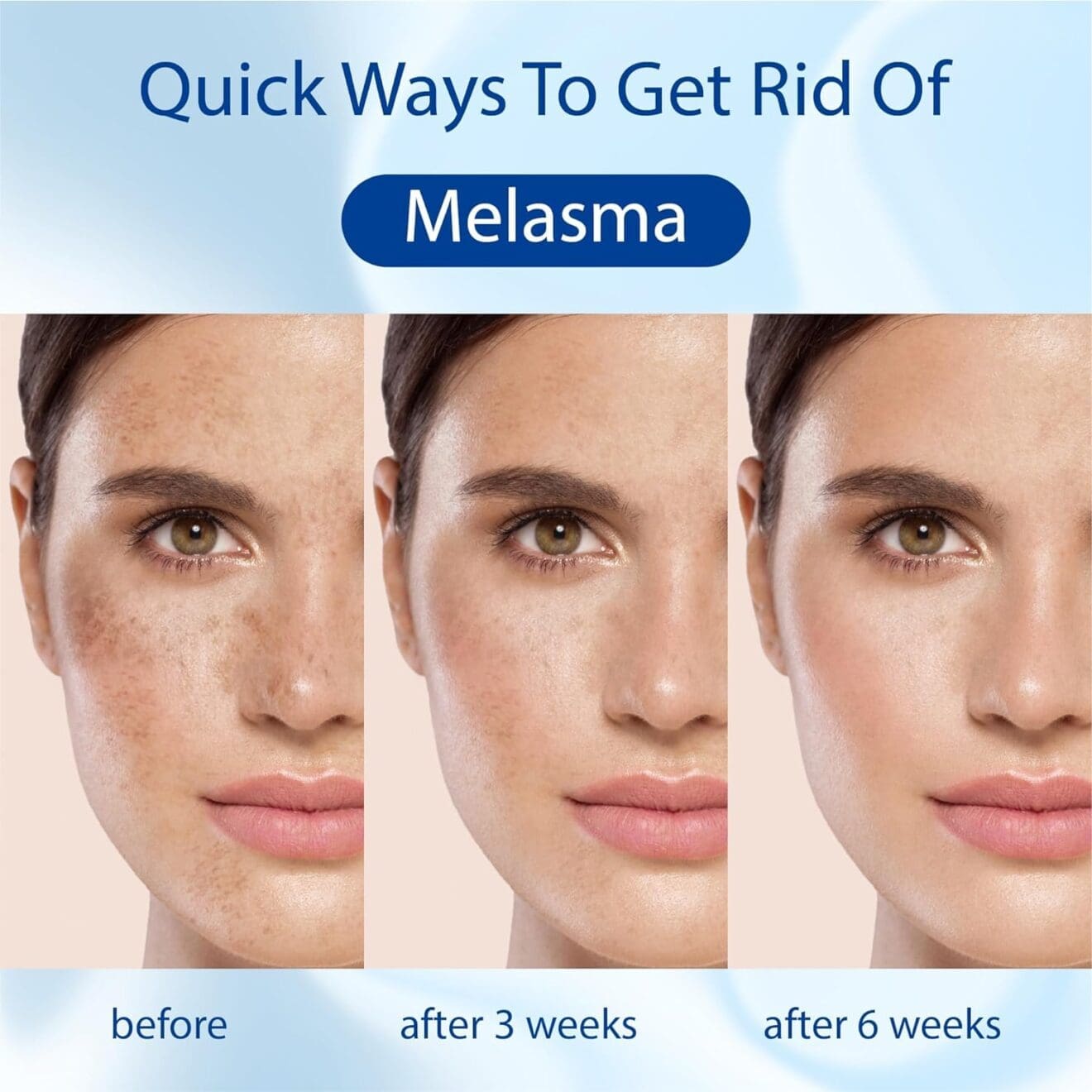 Retinol For Melasma - Melasma Care - Serene Skin Health