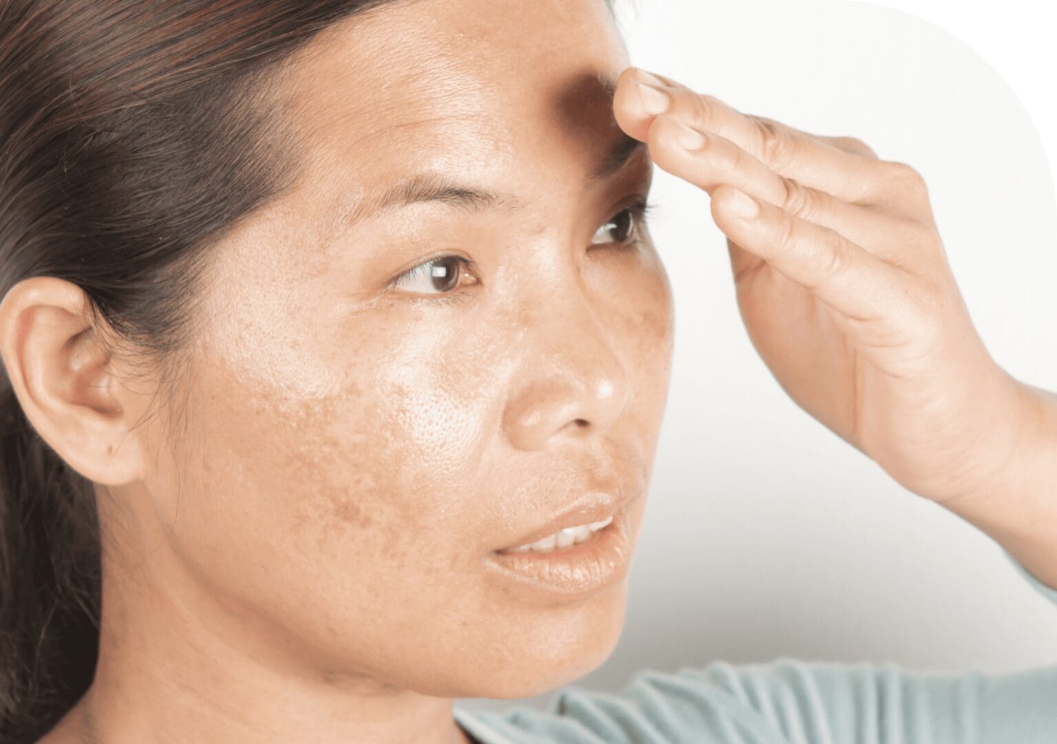 What Is Melasma And Chloasma - Chloasma Care - Serene Skin